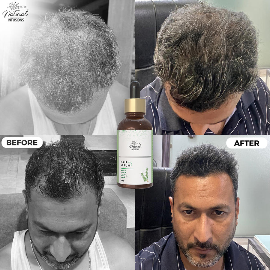 Hair Growth Serum for Natural Regrowth and Shine - Natural Infusions Store